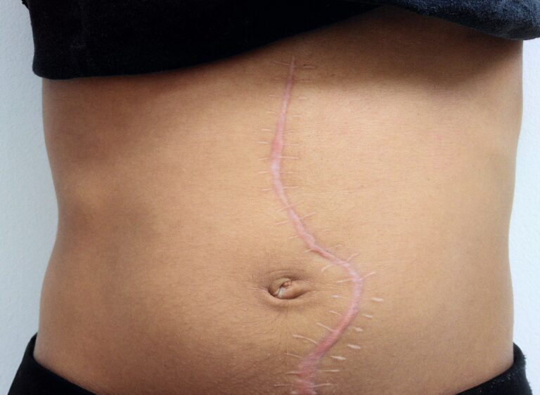 Exploratory Laparotomy - Khobragade Multispeciality Hospital