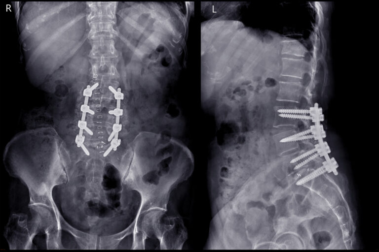 Revision Spine Surgery Failed Back Surgery Syndrome Fbss 8709